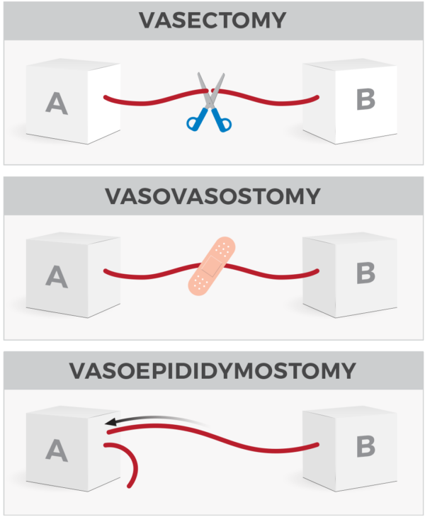 What Is the Vasectomy Reversal Success Rate?